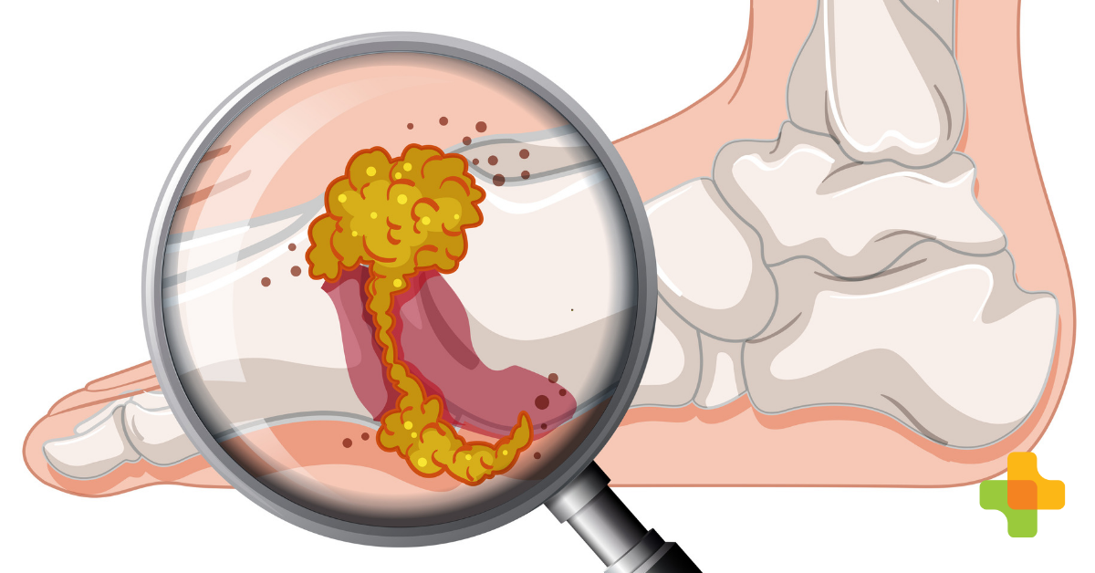Home Remedies For Gout Pain